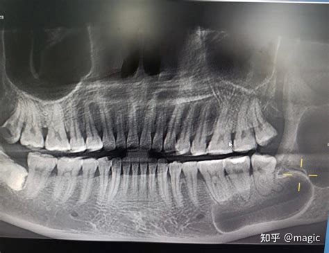📝记录颌骨囊肿 知乎