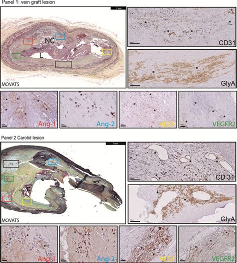 Leaky Neovessels In Human Vein Graft And Carotid Lesions A Human