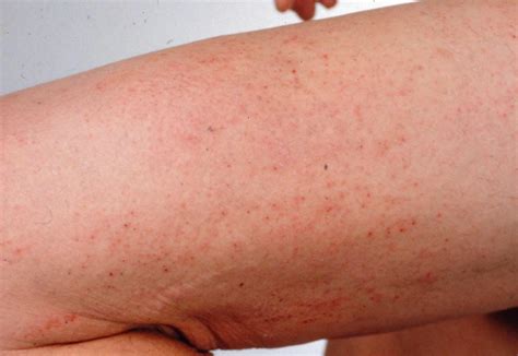 Dermatitis Herpetiforme Full Article Dermatitis Herpetiformis A