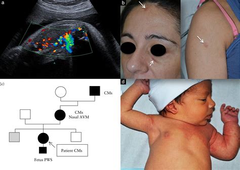 Prenatal Diagnosis Of Cerebral And Extracerebral High‐flow Lesions