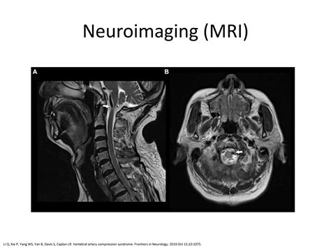Vertebral Artery Compression Syndromepptx