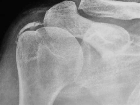 Calcific Tendinitis Of Shoulder Pptx