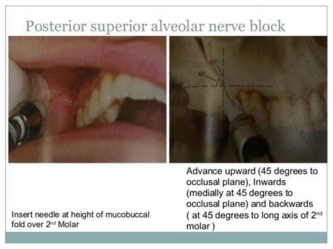 Posterior Superior Alveolar Block