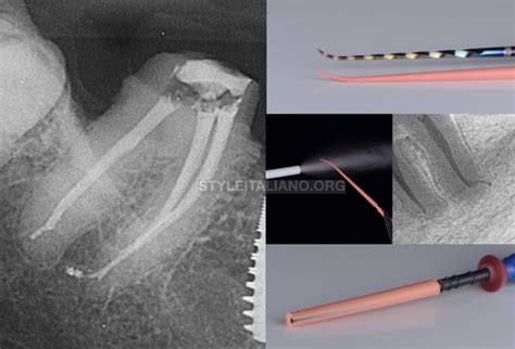 Obturation Of Root Canals With Impediments Style Italiano Endodontics