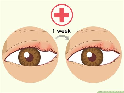 Swollen Eyelid Due To Makeup Allergy Saubhaya Makeup