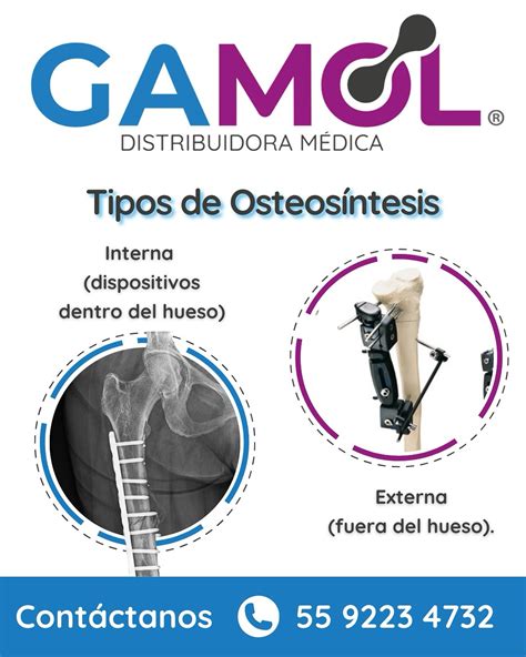 Gamol ¿sabías Que Existen Dos Tipos De Osteosíntesis En Gamol Te