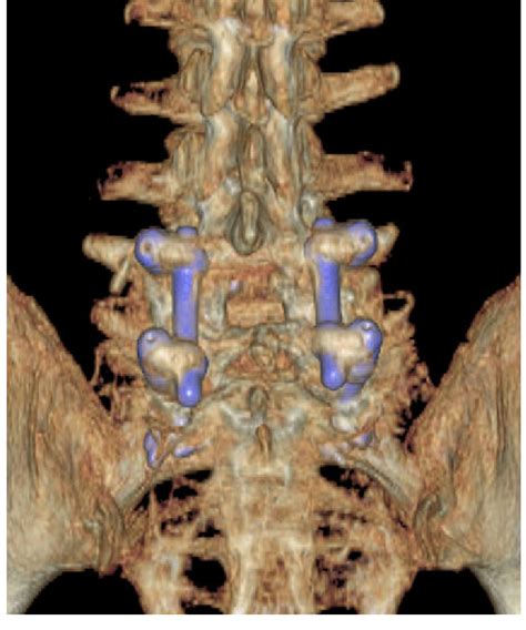 A 3d Ct Reconstruction With An Evident Posterolateral Bone Fusion Mass
