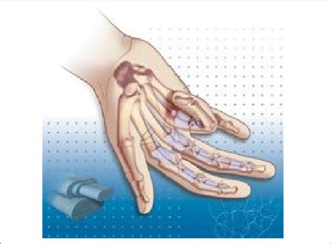 Graphical Representation Of The Trigger Ring Finger Showing A Nodule