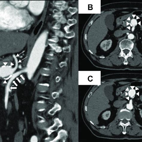 Michels Classification Of The Hepatic Arteries Download Table