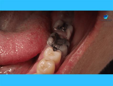 What Is Non Restorable Tooth