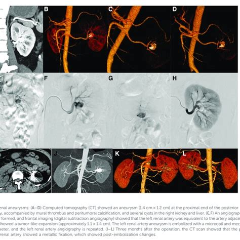 A According To The Morphological Classification Of Renal Aneurysms