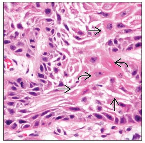 Squamous Cell Carcinoma Basicmedical Key
