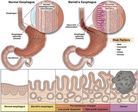 Barrett Esophagus Ppt At Nancy Sheridan Blog