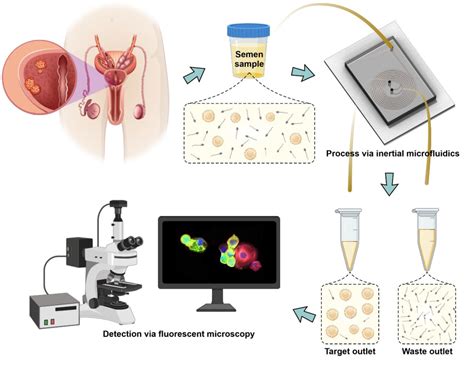 Figure 1 From Isolation Of Circulating Tumor Cells From Seminal Fluid
