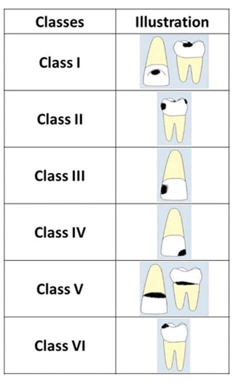The Six Classes Of Carious Oraa Care Smile Dental Clinic Facebook