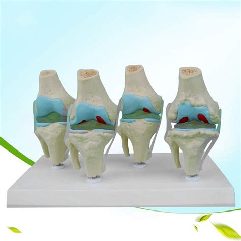 Buy Xieji Knee Joint Pathology Model Life Size Human Anatomy Morbid