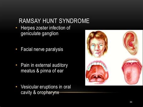 Ramsay Hunt Syndrome Causes Shingles Nerve Vagus System Herpes Zoster