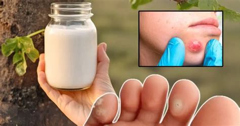 Fig Tree Latex Natural Remedies For Warts Boils Headaches And More