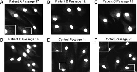 Picogreen Staining Reveals Marked Mtdna Depletion In Certain Mds