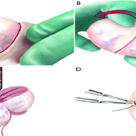 Courtesy 62 Microdissection Testicular Sperm Extraction The