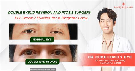 Double Eyelid Revision And Ptosis Surgery Fix Droopy Eyelids
