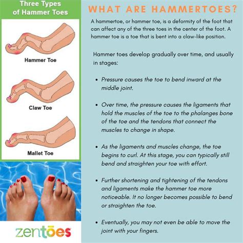 Are You Glad That Sandal Season Is Over In Many Places Due To Bent Toes