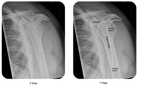 Shoulder Dislocation Orthosho