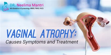 Vaginal Atrophy Causes Symptoms And Treatment