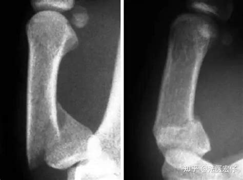 第一掌骨基底部骨折，详细手术要点（优秀摘录） 知乎