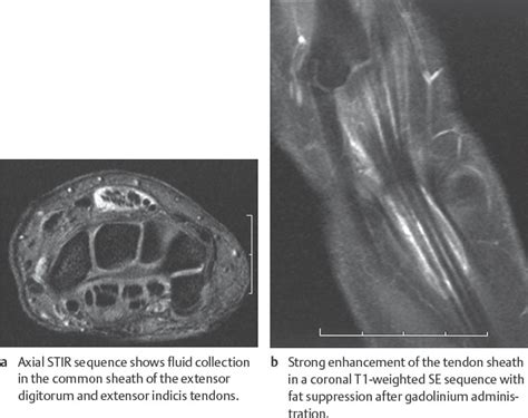 Extensor Pollicis Longus Mri
