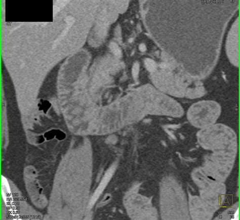 Polyposis Syndrome With Multiple Duodenal Polyps Small Bowel