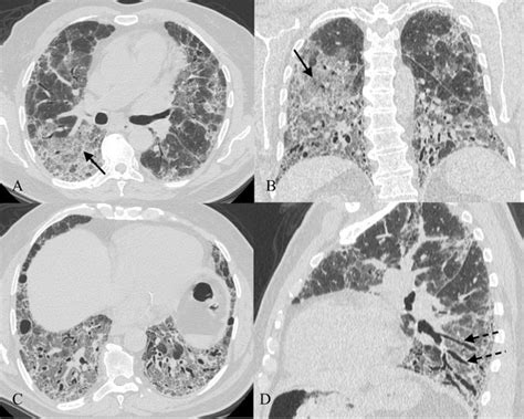 Nsip Pattern In A 64 Year Old Man Hrct Features Of Nsip Include Download Scientific Diagram