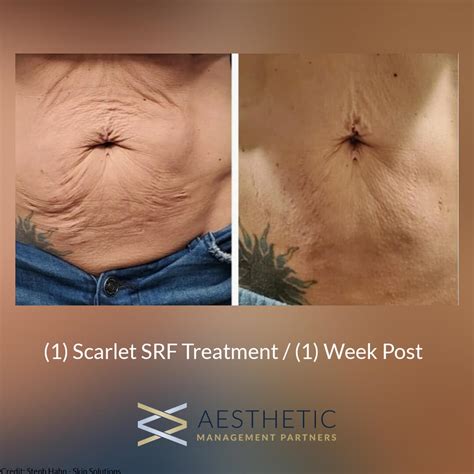 Scarlet Srf Microneedling Medical Spa In Montgomery Al