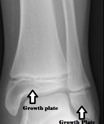 Impact Of Exercise On Puppy Growth Plates Dog Discoveries