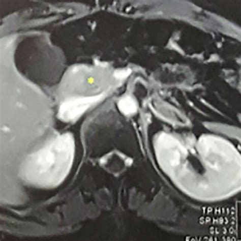 Mri Abdomen Revealed A Hypointense Irregular Mass Yellow Starred In Download Scientific