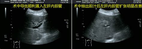 【湖滨院区】成功实施超声引导下经皮穿刺左右肝内胆管置管双引流术杭州市第一人民医院