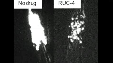The Future Of Stemi Care A New Treatment For Bridging The Gap From