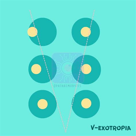 V Pattern Strabismus — Ophthalmobytes