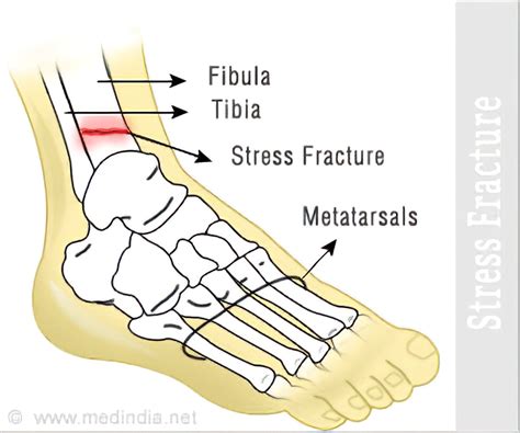 Stress Fracture Healing Tips