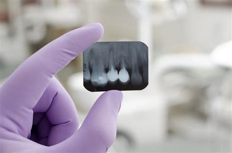 Can Dental X Rays Detect Cavities Between Teeth Rebecca E Reeves