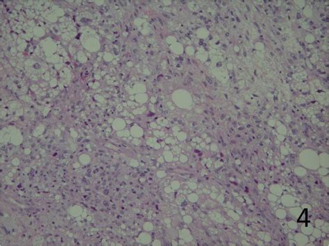 Pleomorphic Liposarcoma Tumor Surgery Network