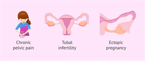 What Is Salpingitis Causes Symptoms And Treatment