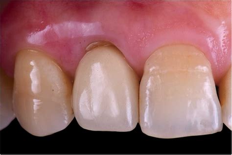 Minimally Invasive Management Of A Socket Shield Technique Complication
