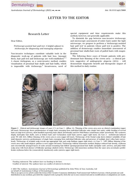 Pdf Trichoscopy‐assisted Hair Pull Test A Helpful Adjunct To Trichoscopy For Diagnosing And