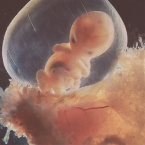 Anencefalia Causas E Sintomas Da Má Formação Do Cerebro Do Feto