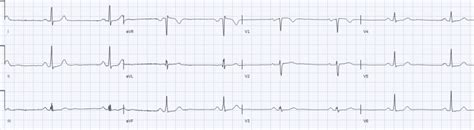 Ecg Artifact And Lead Misplacement Ecg Cases Em Cases