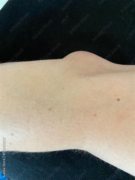 Olecranon Bursitis Is Sometimes Called Popeyes Elbow” Bursitis Is A