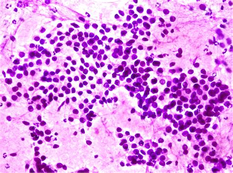 Nuclear Crowding Papanicolaou Stain × 400 Download Scientific Diagram