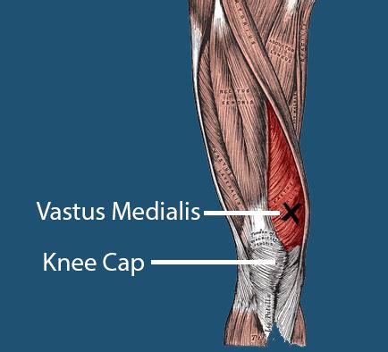 Vastus Medialis Exercises