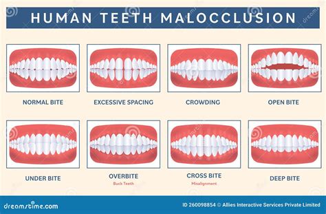 Malocclusion Of The Human Teeth Infographic Icon Set Over Peach Stock